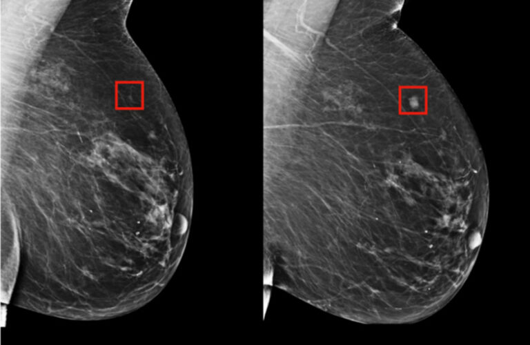 Using Ai And Ml To Revolutionise Early Breast Cancer Detection